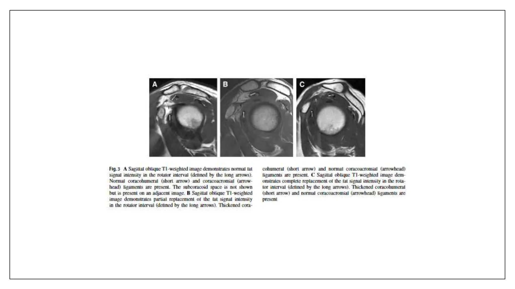 Posterior capsule edema in adhesive capsulitis.pptx