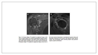 Posterior capsule edema in adhesive capsulitis.pptx