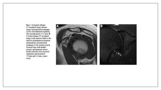 Posterior capsule edema in adhesive capsulitis.pptx