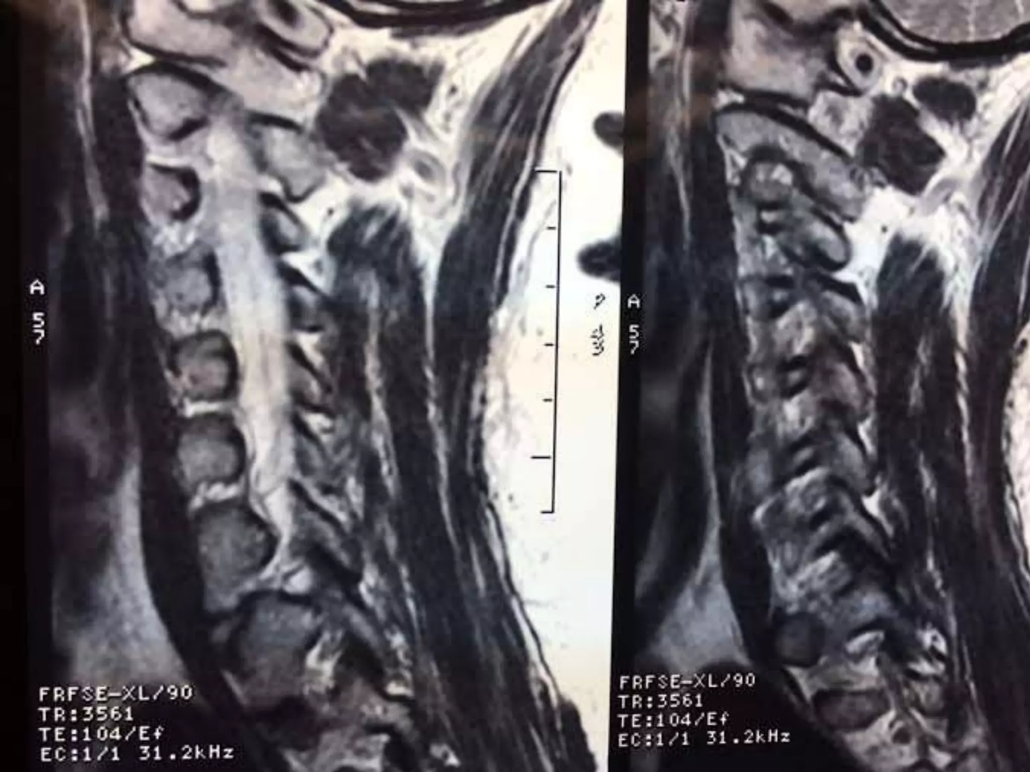 Posterior cervical facet arthrosis | PPT