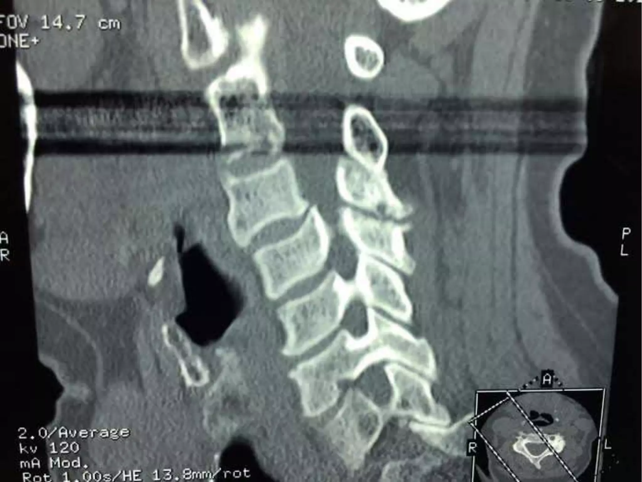 Posterior cervical facet arthrosis | PPT