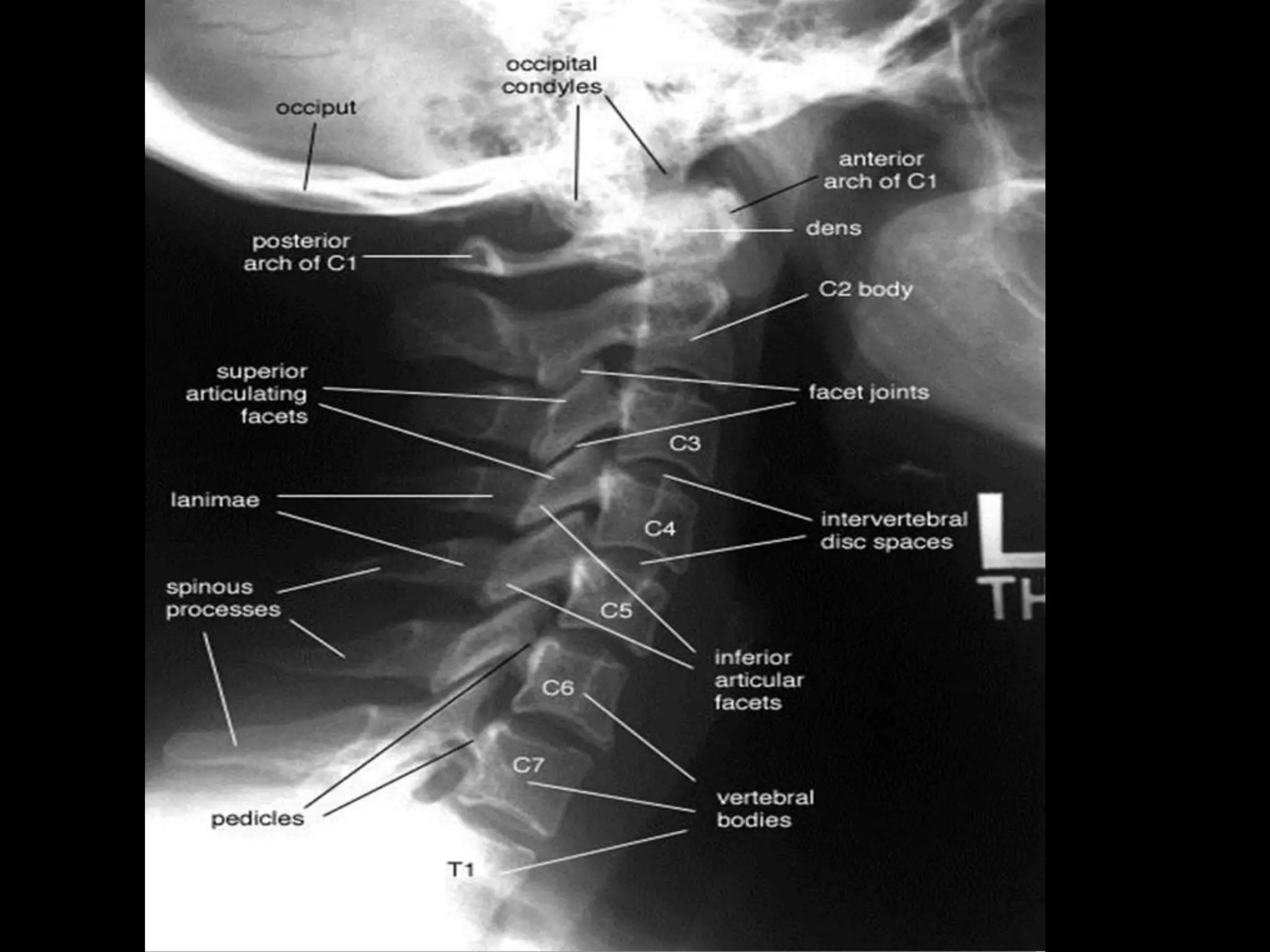 Posterior cervical facet arthrosis | PPT