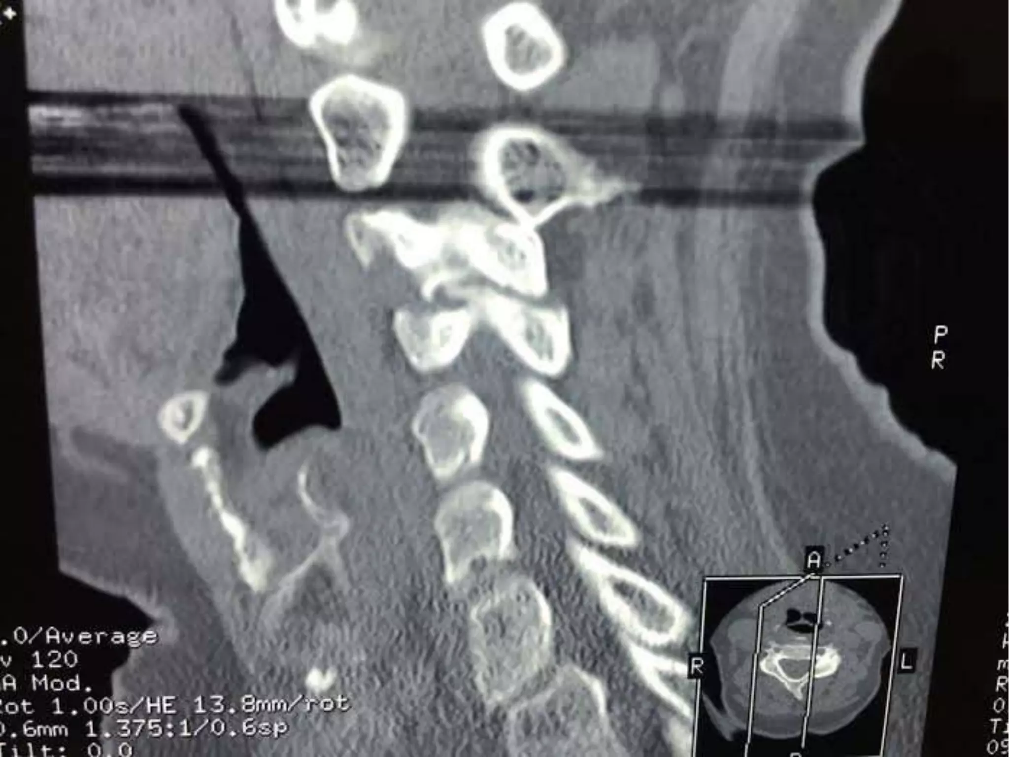 Posterior cervical facet arthrosis | PPT