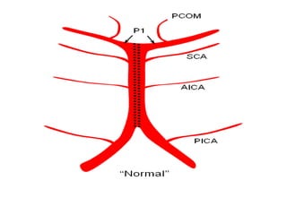 Posterior circulation ischaemic stroke and tia | PPTX