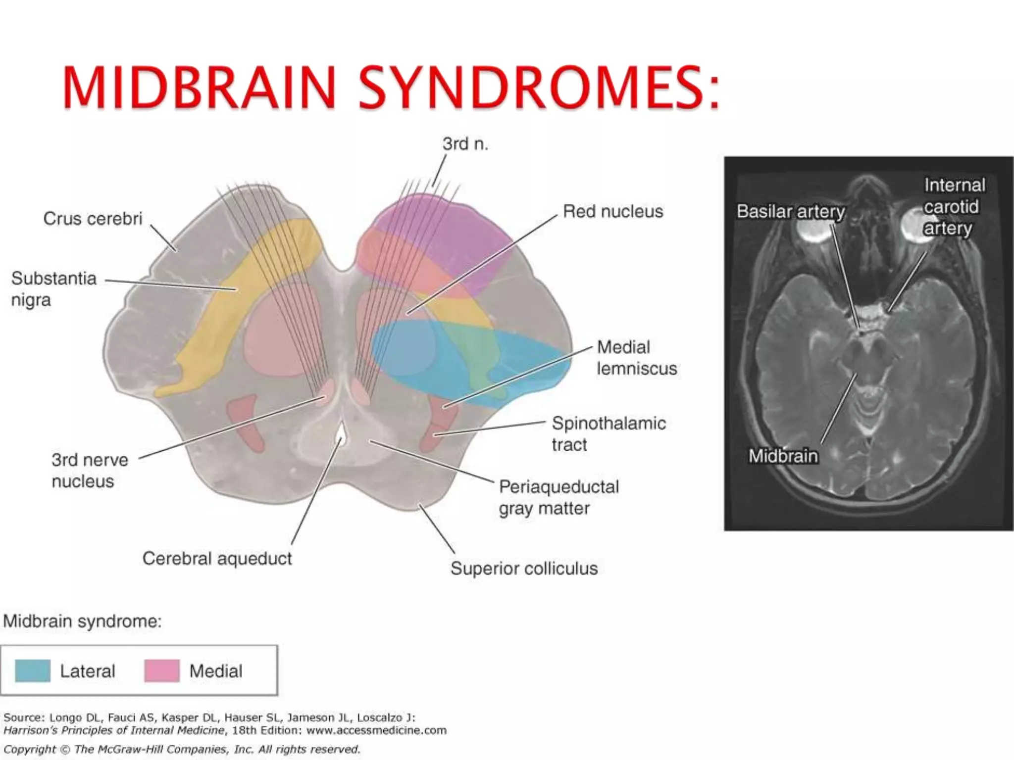 Posterior circulation stroke | PPTX