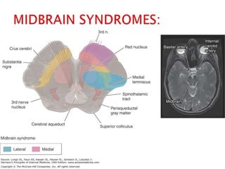 Posterior circulation stroke | PPTX