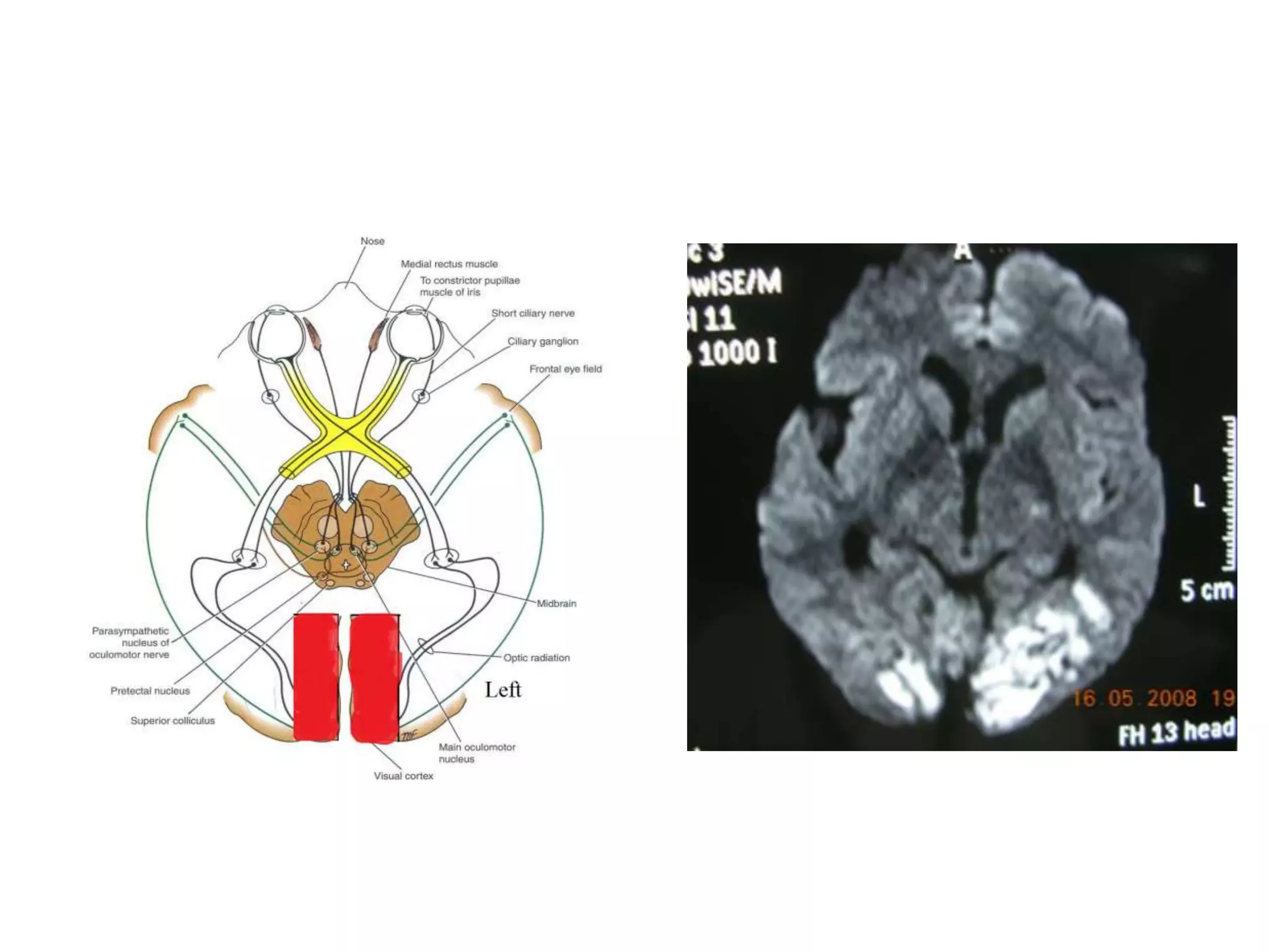 Posterior circulation stroke Syndromes | PPTX