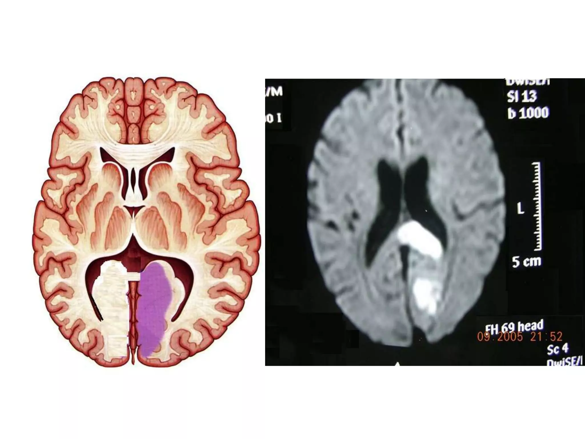 Posterior circulation stroke Syndromes | PPTX