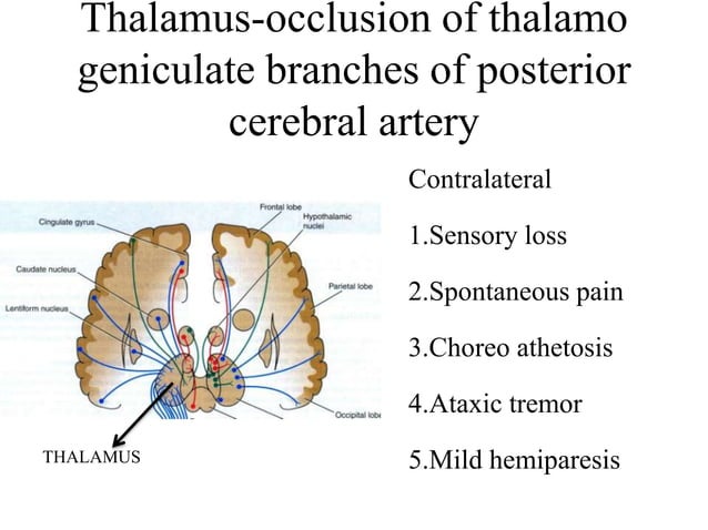 Posterior circulation stroke Syndromes | PPTX | Brain and Nervous ...