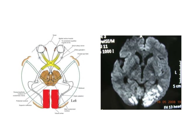 Posterior circulation stroke Syndromes | PPTX | Brain and Nervous ...