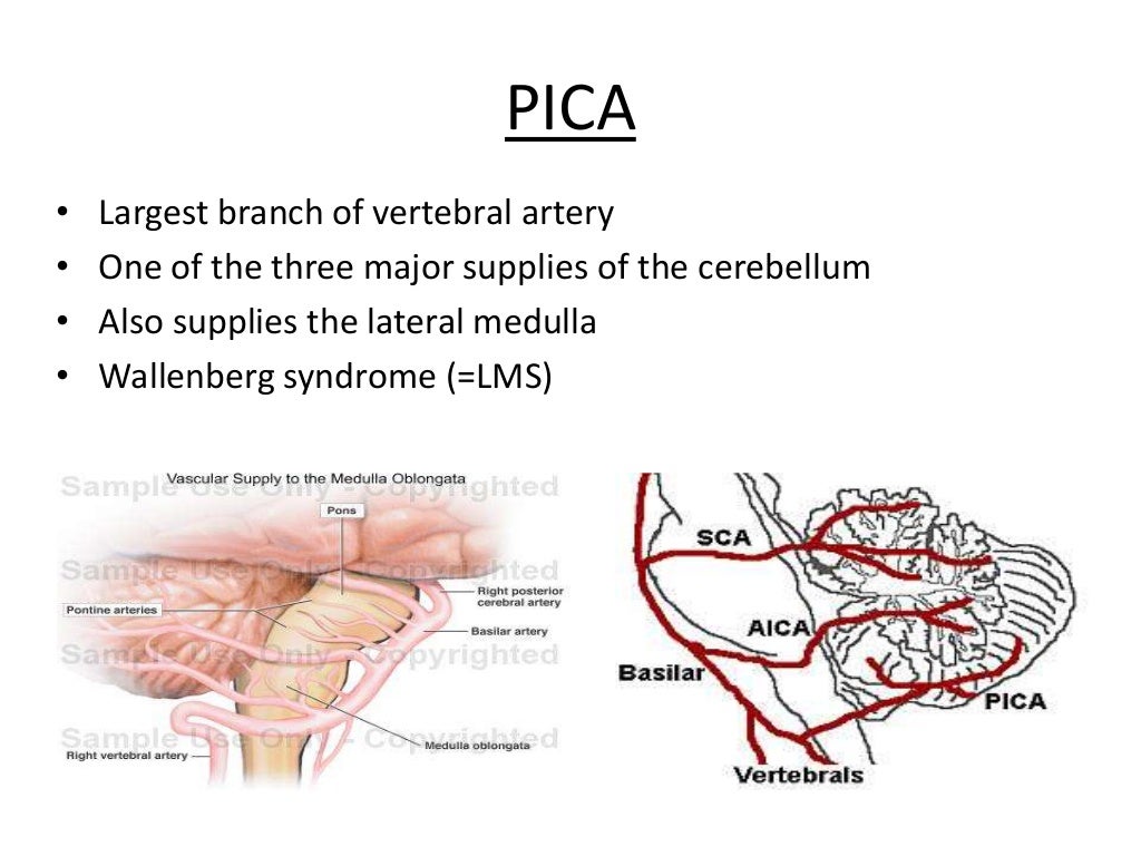 Posterior circulation stroke Syndromes