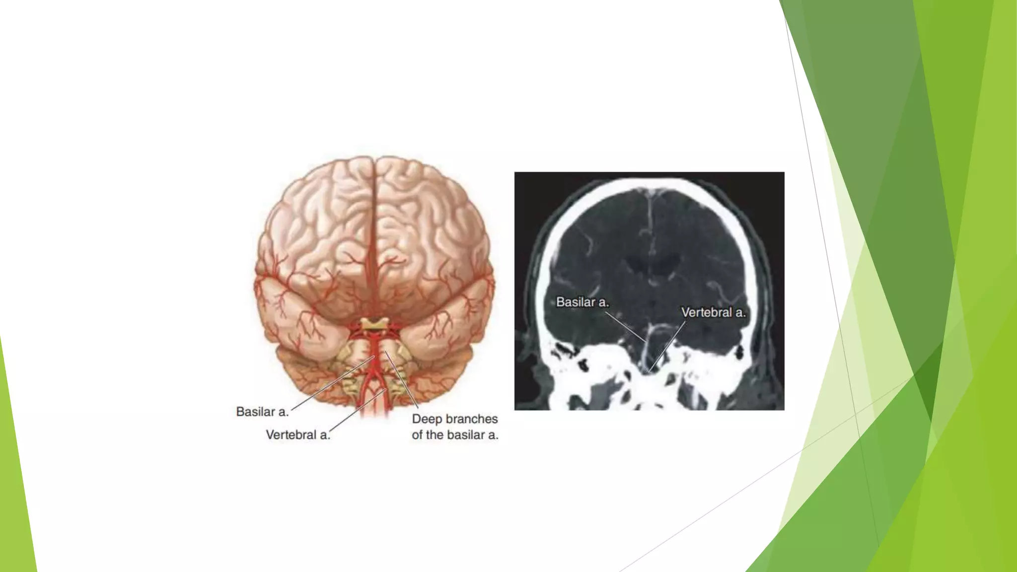 posterior circulation stroke.pptx