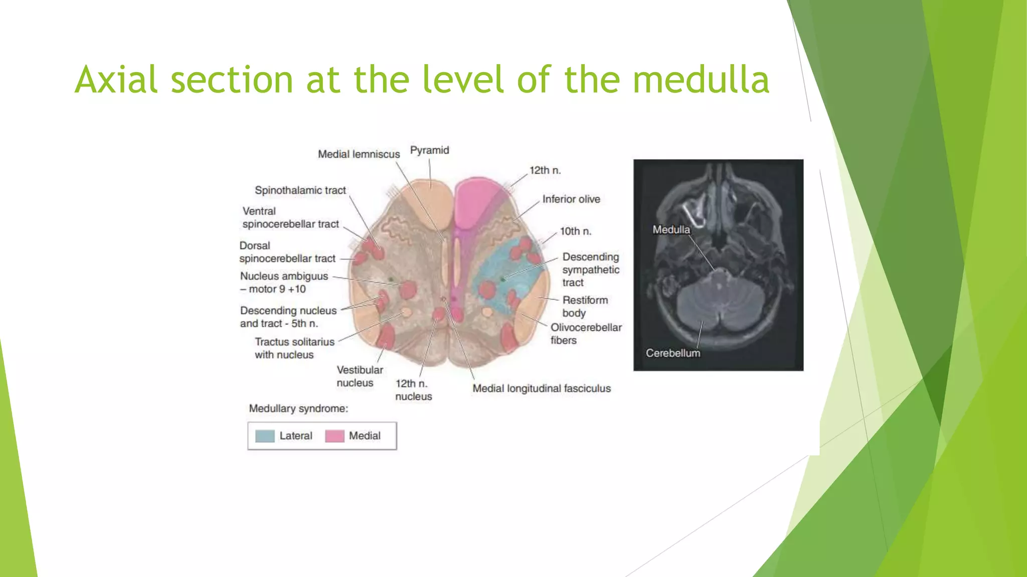 posterior circulation stroke.pptx