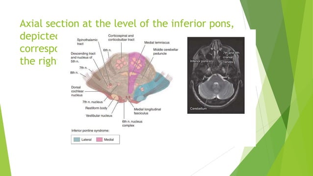 posterior circulation stroke.pptx