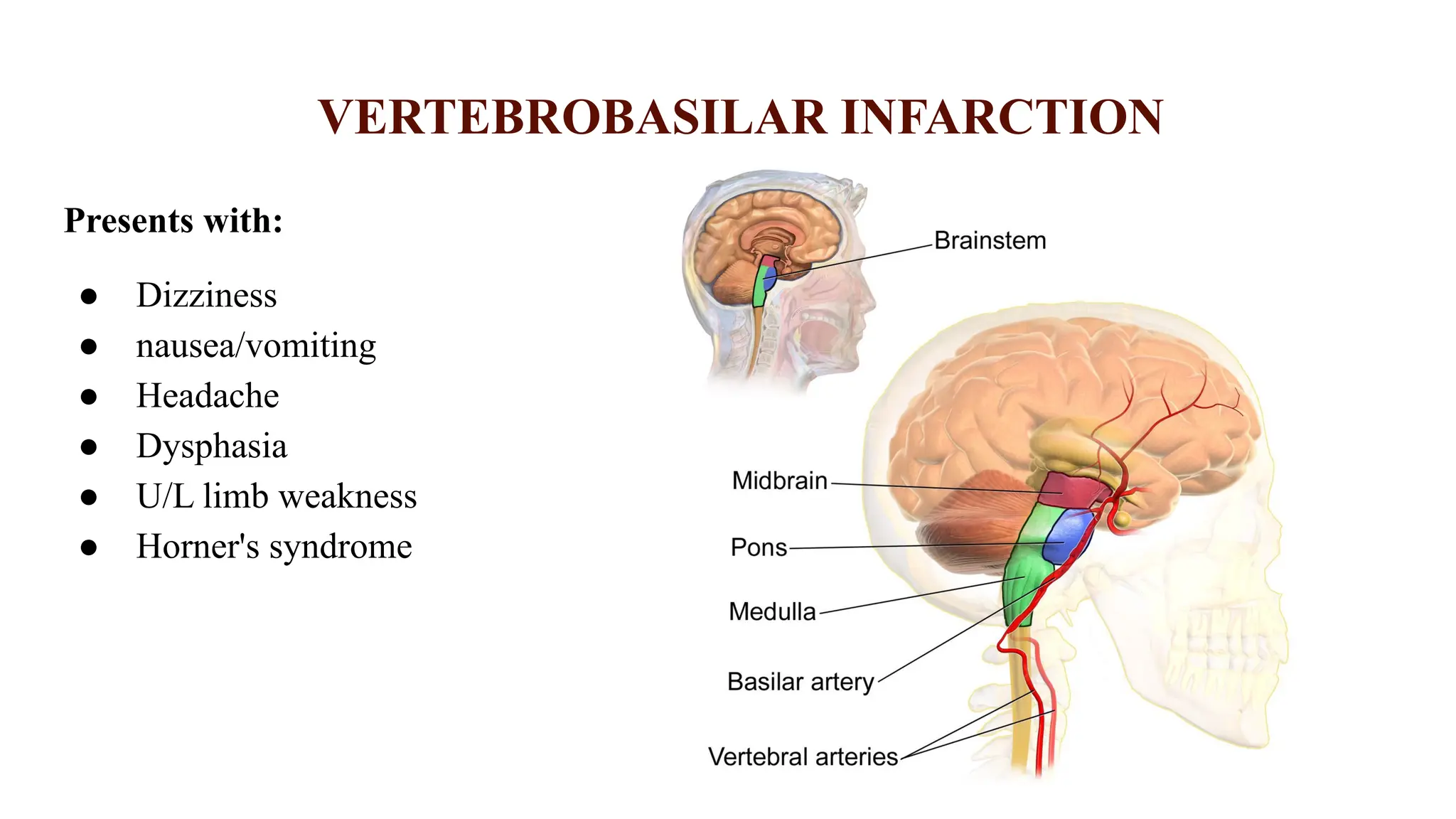 posterior circulation ischemic/embolic stroke | PDF