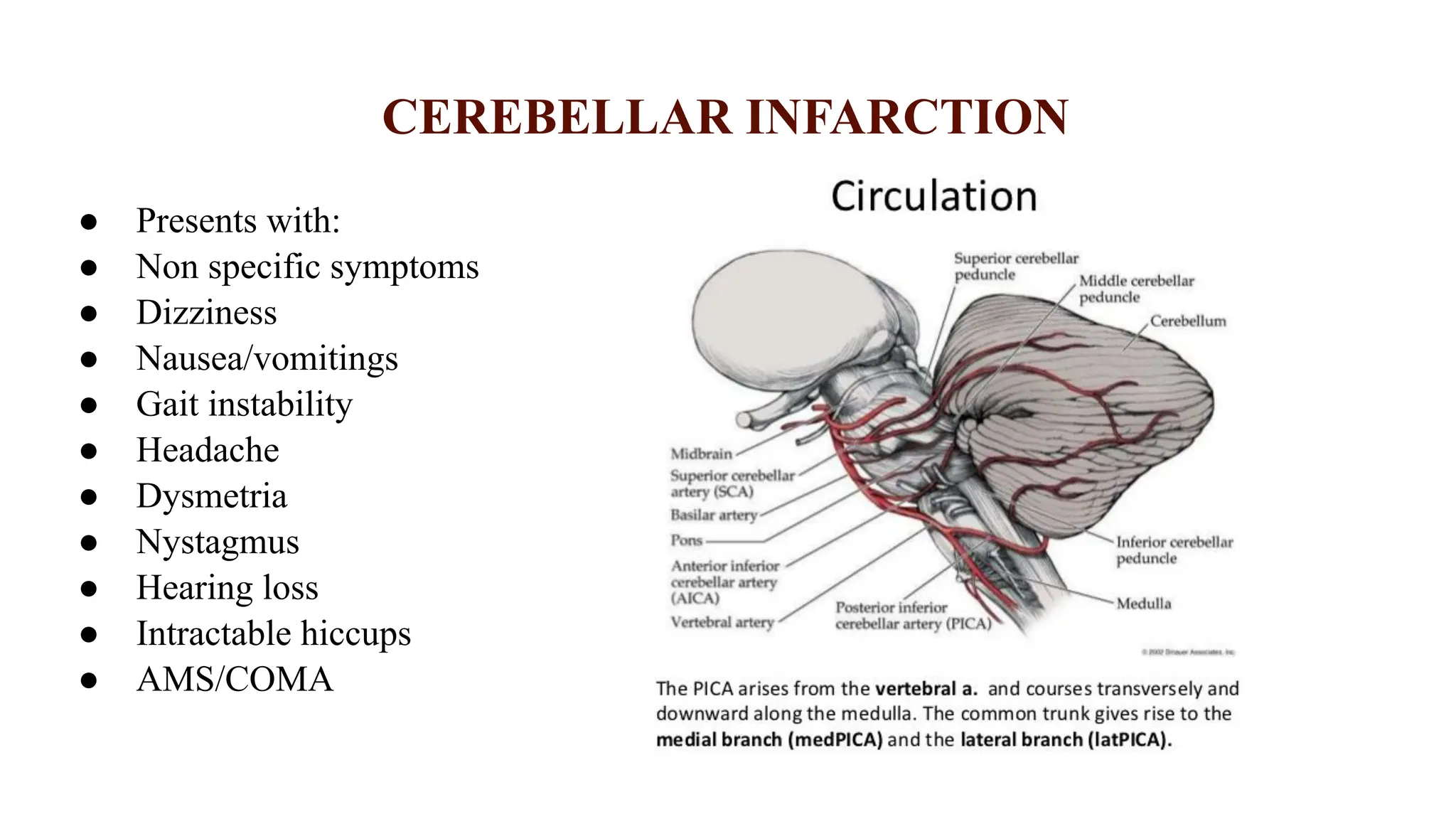 posterior circulation ischemic/embolic stroke | PDF