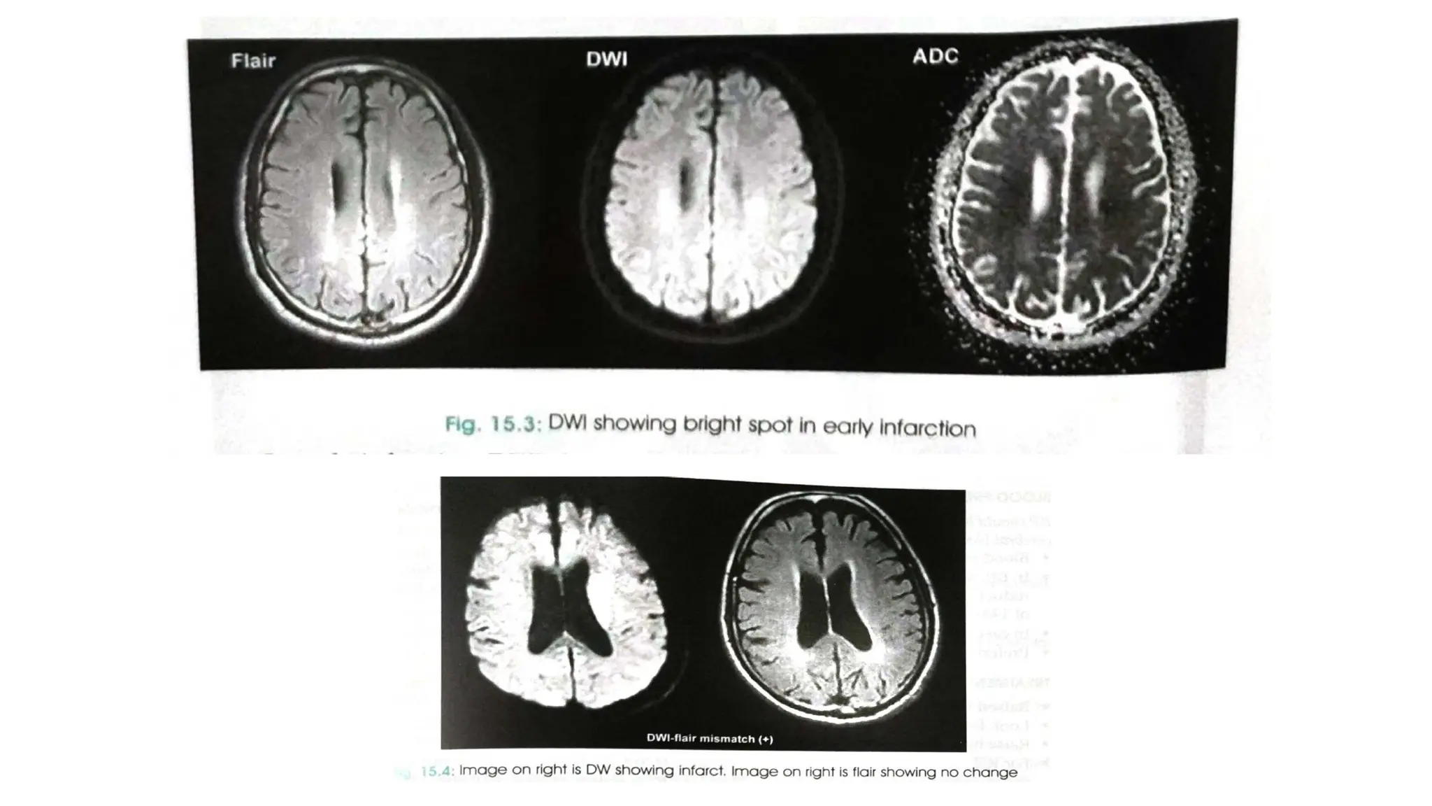 posterior circulation ischemic/embolic stroke | PDF