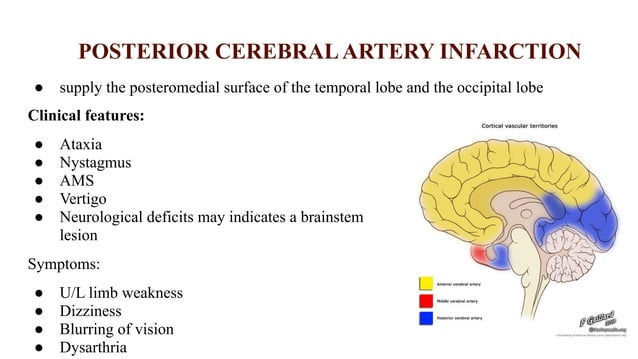 posterior circulation ischemic/embolic stroke | PDF
