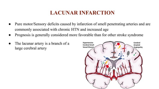 posterior circulation ischemic/embolic stroke | PDF