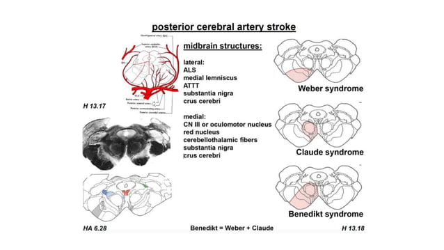 Posterior circulation stroke syndromes - Dr Sameep Koshti (consultant Neurosurgeon) | PPTX