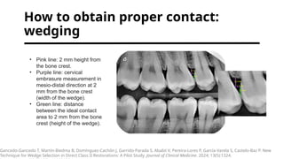 posterior composite.pptx about copmosire | PPTX | Dental Health ...
