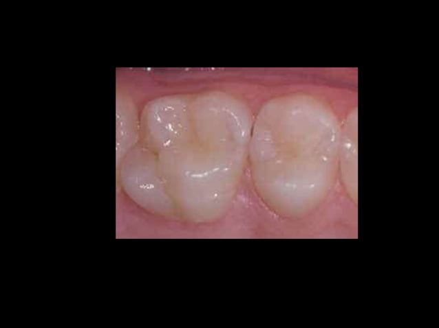 Posterior composites | PPTX