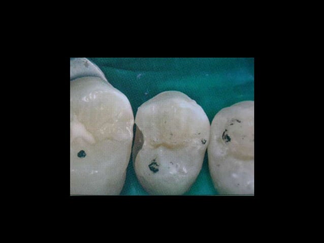 Posterior composites | PPTX