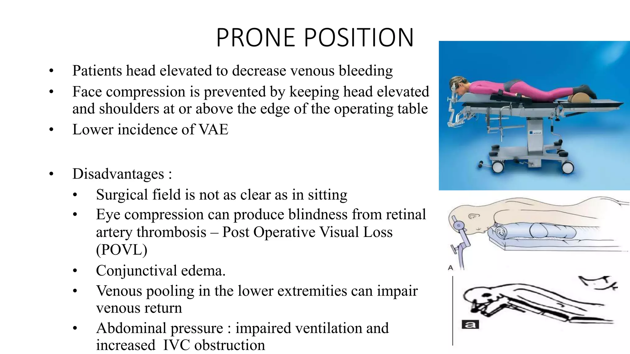posterior cranial fossa surgery and anaesthesia | PPTX