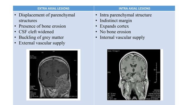 posterior cranial fossa surgery and anaesthesia | PPTX