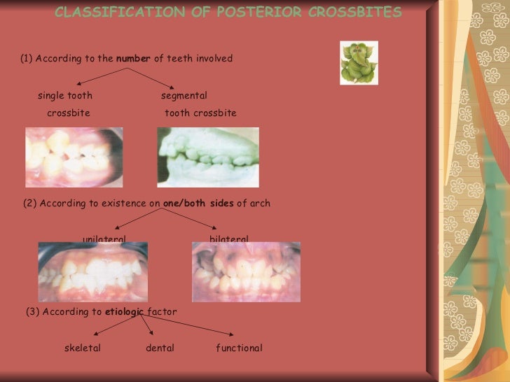 Posterior crossbite in_primary_and_mixed_dentition_-_etiology_and_man…
