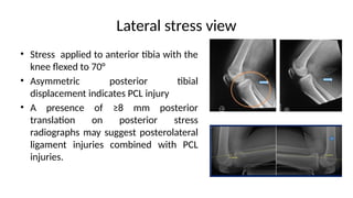 Posterior cruciate ligament injuries.pptx
