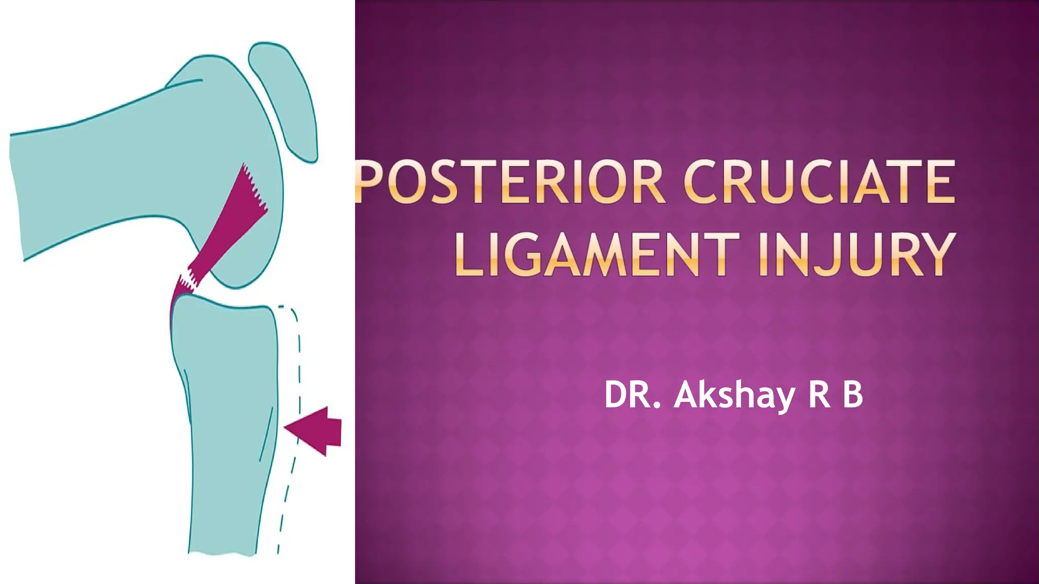 posterior cruciate ligament injury.ppt. . | PPT