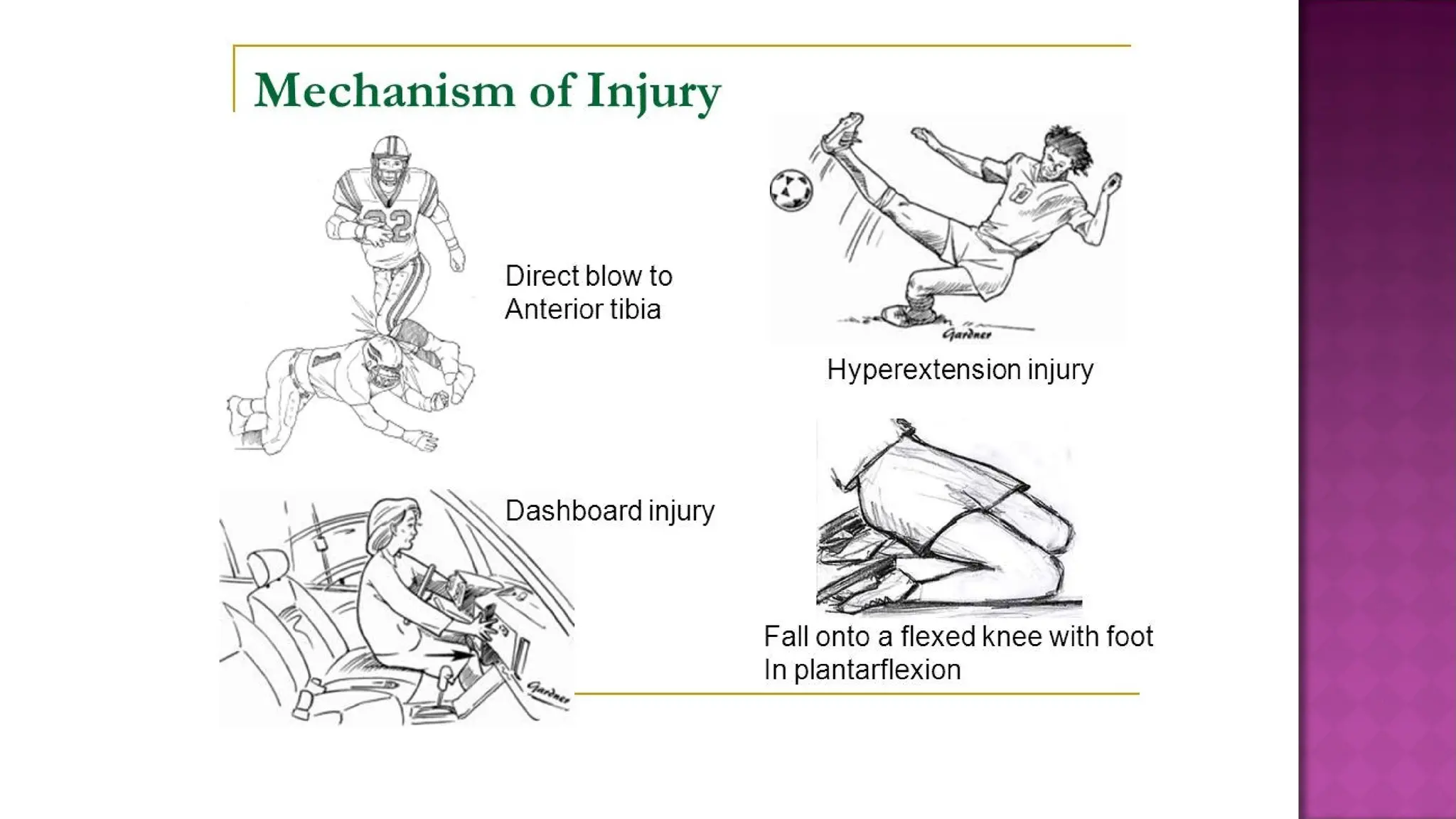 posterior cruciate ligament injury.ppt. . | PPT