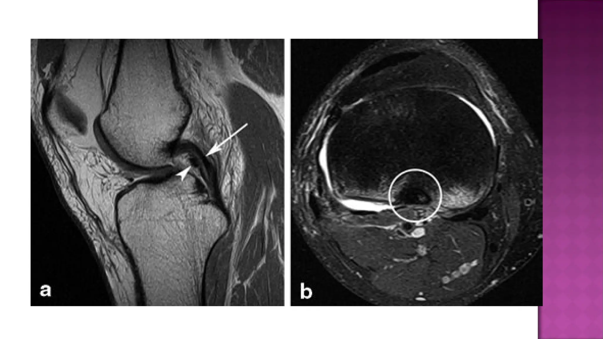 posterior cruciate ligament injury.ppt. . | PPT