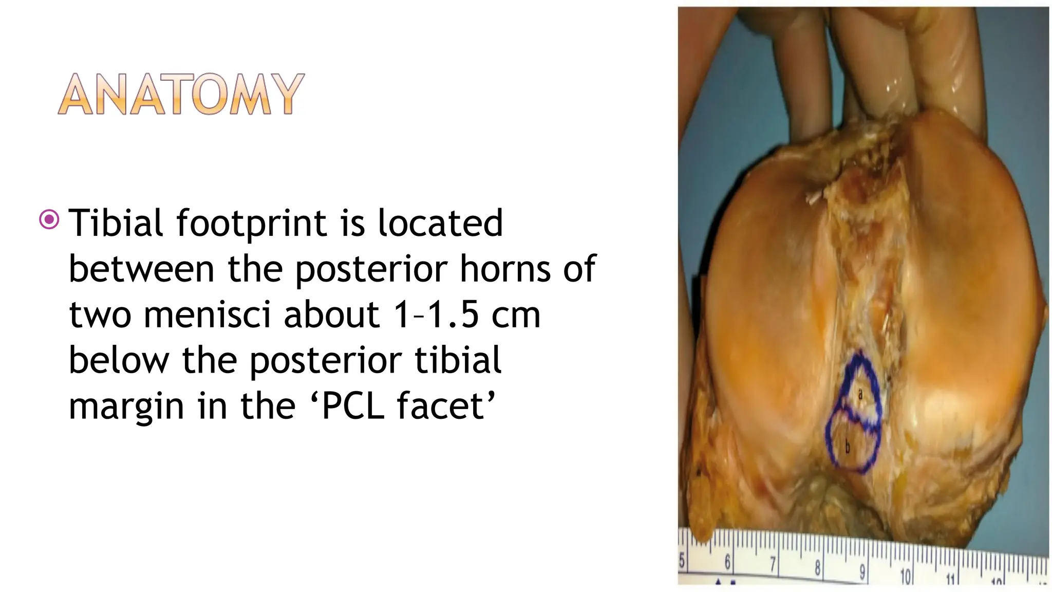 posterior cruciate ligament injury.ppt. . | PPT