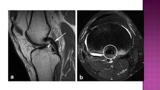 posterior cruciate ligament injury.ppt. . | PPT