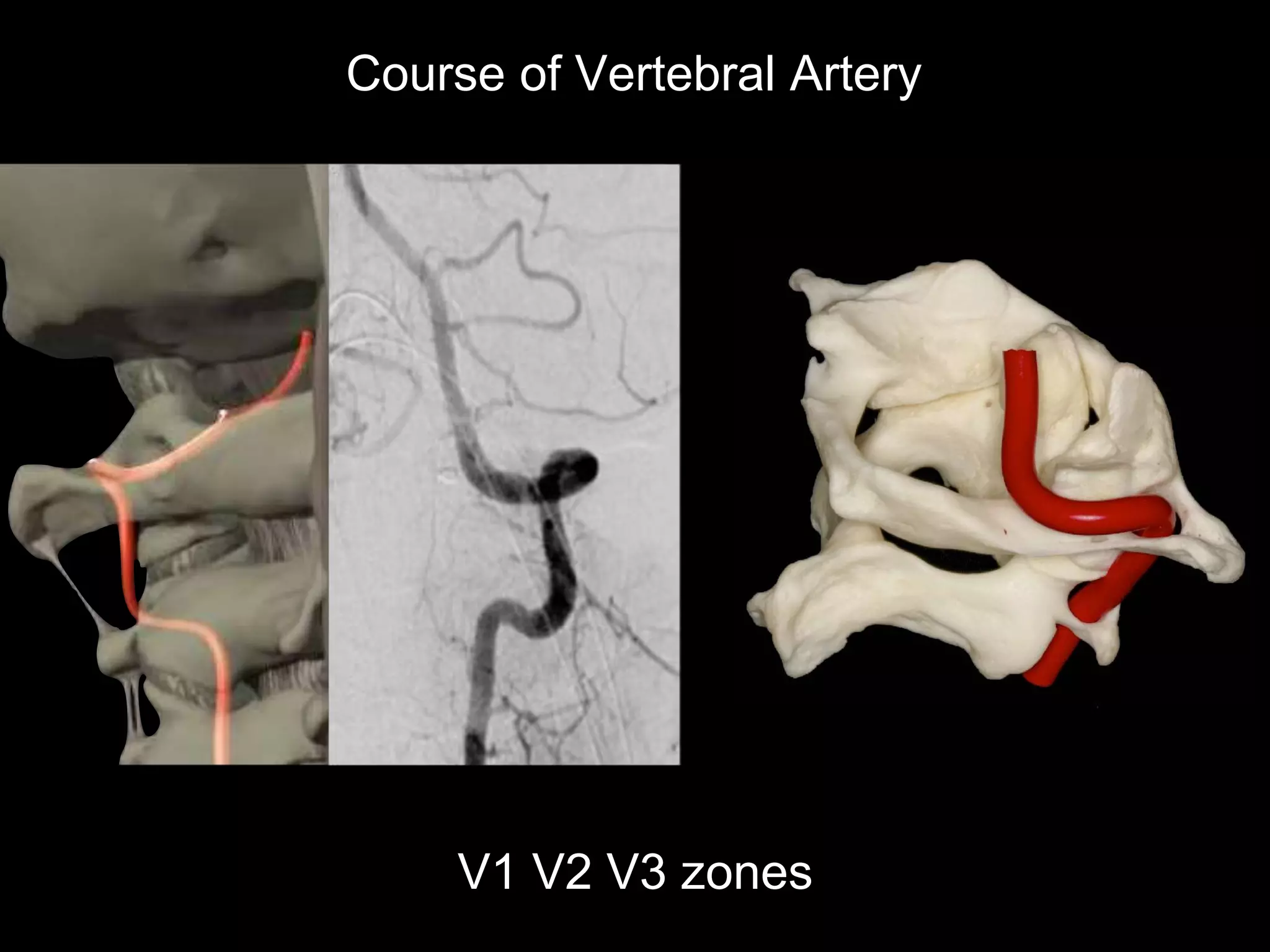 Applied surgical anatomy of the craniovertebral spine | PPTX
