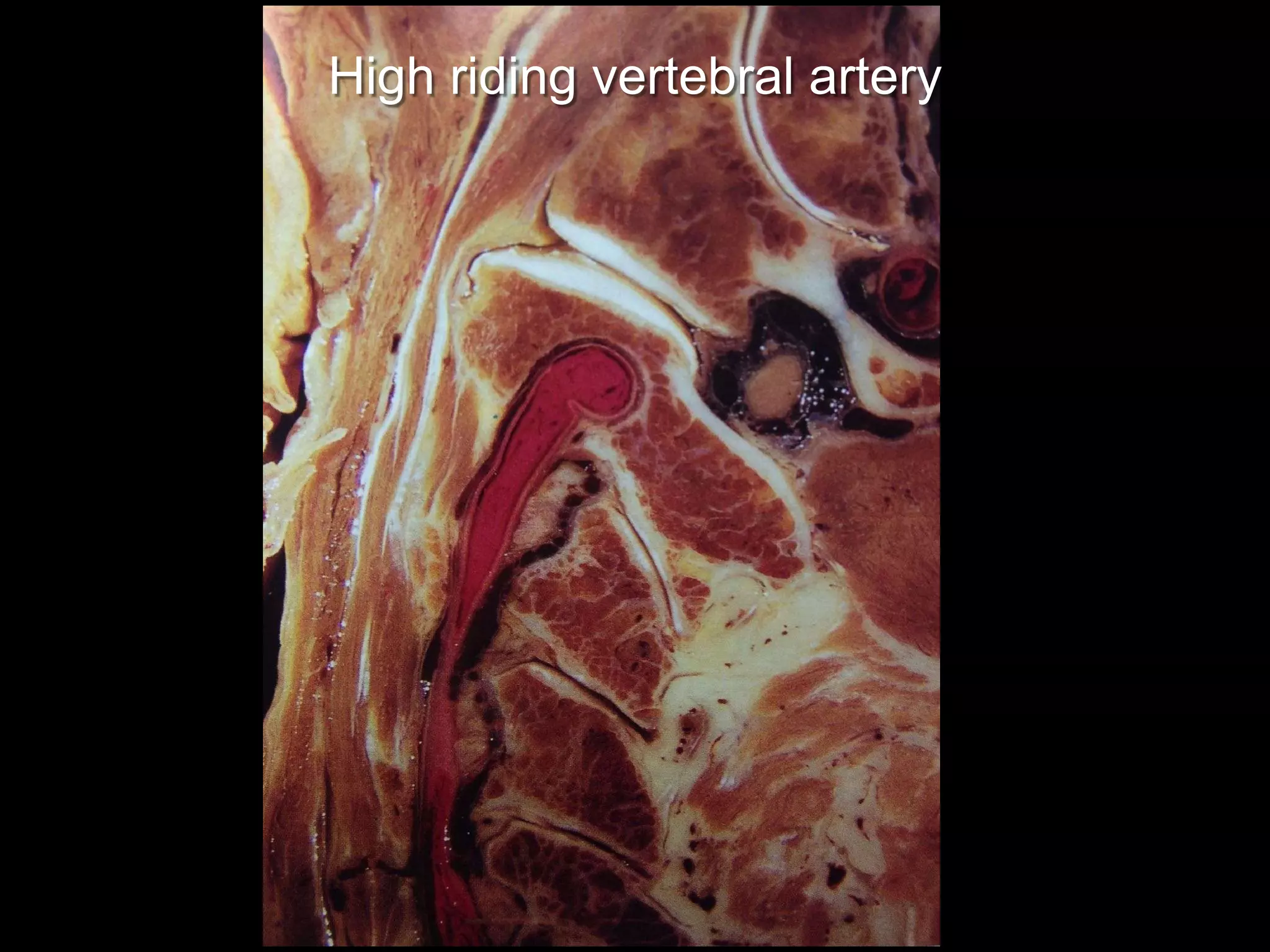 Applied surgical anatomy of the craniovertebral spine | PPTX