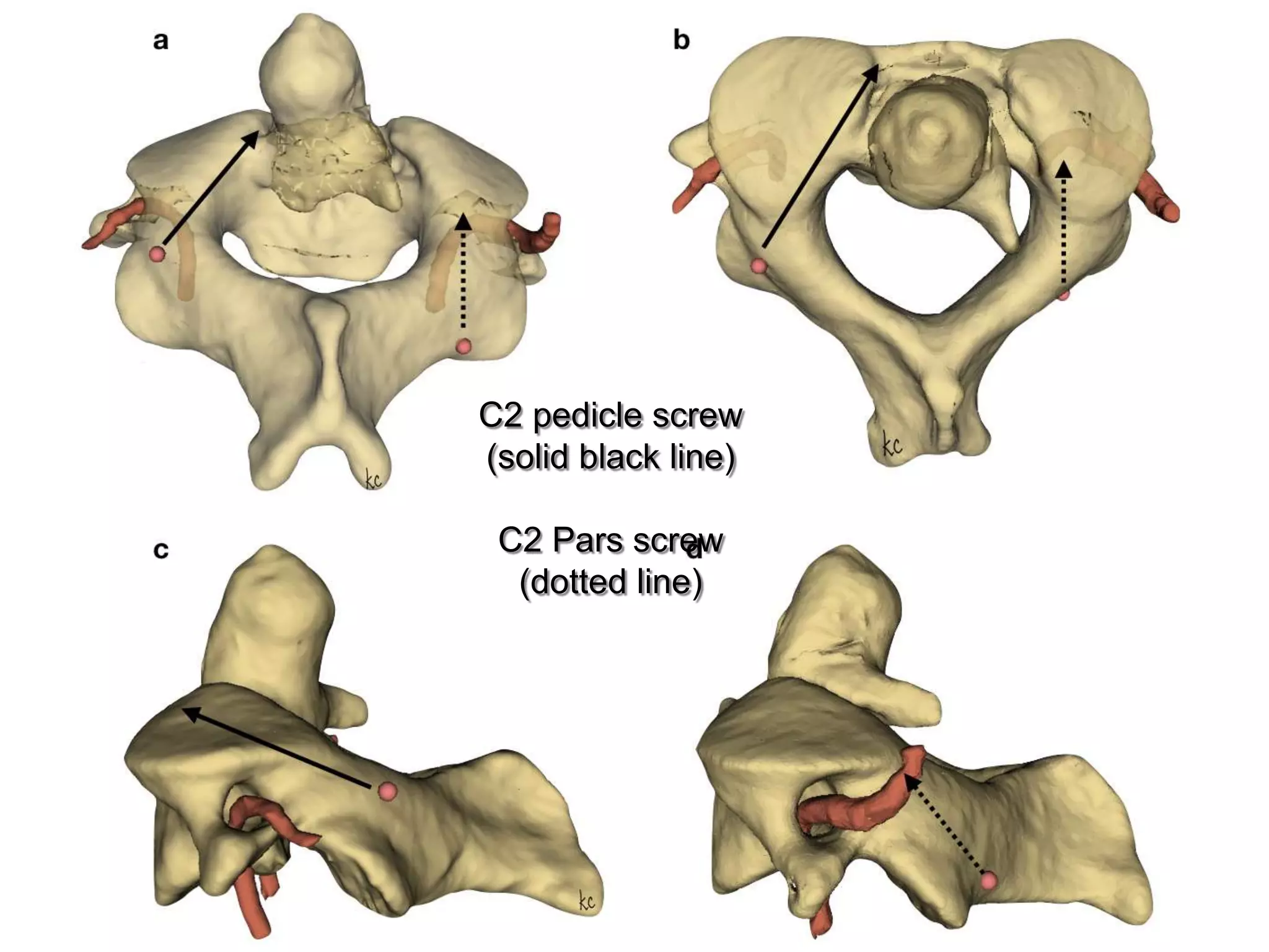 Applied surgical anatomy of the craniovertebral spine | PPTX