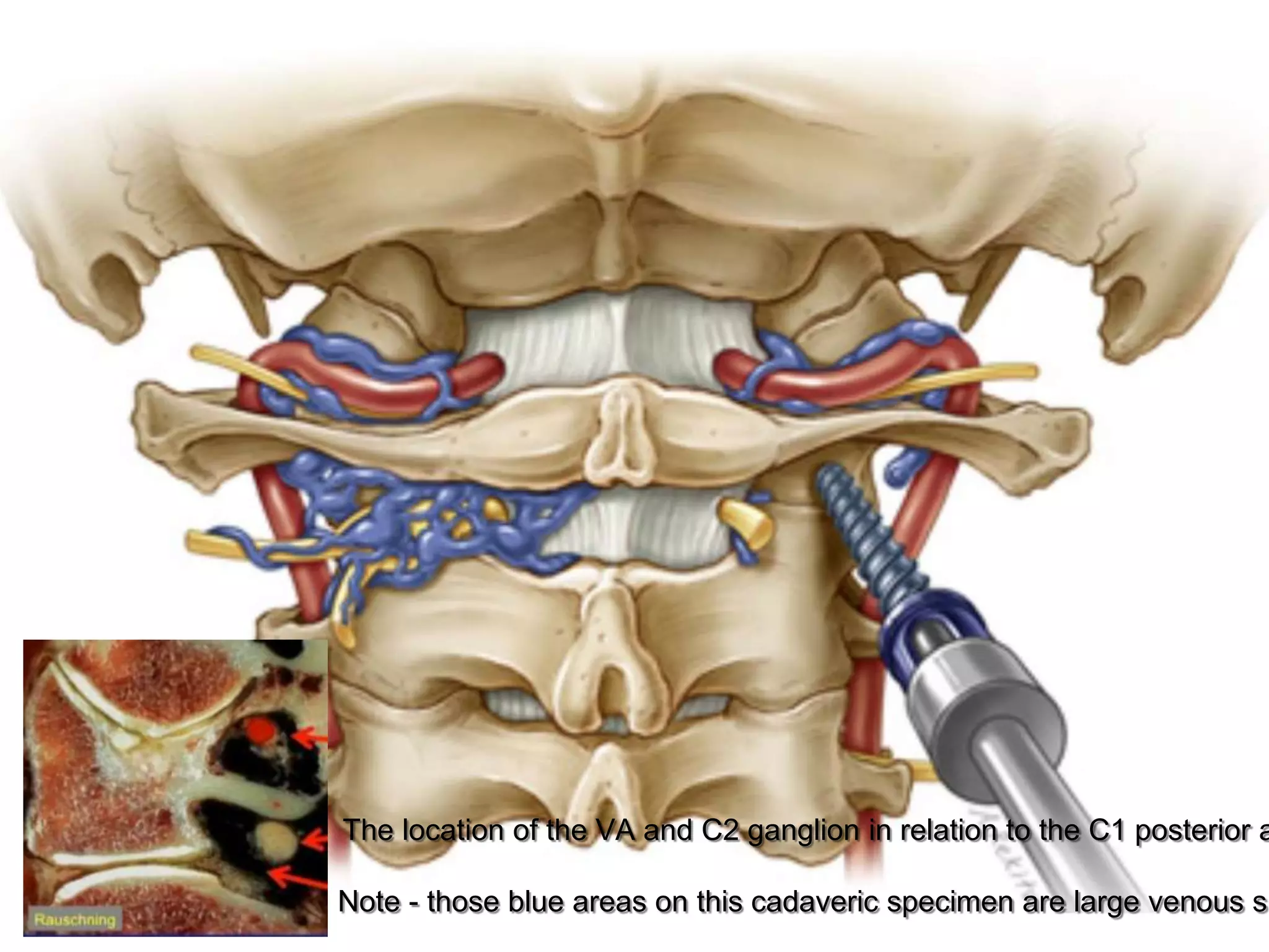Applied surgical anatomy of the craniovertebral spine | PPTX