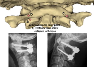 Applied surgical anatomy of the craniovertebral spine | PPTX