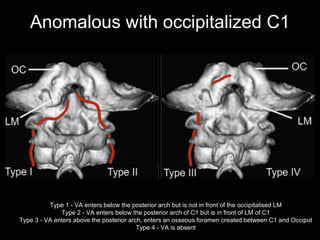 Applied surgical anatomy of the craniovertebral spine | PPTX