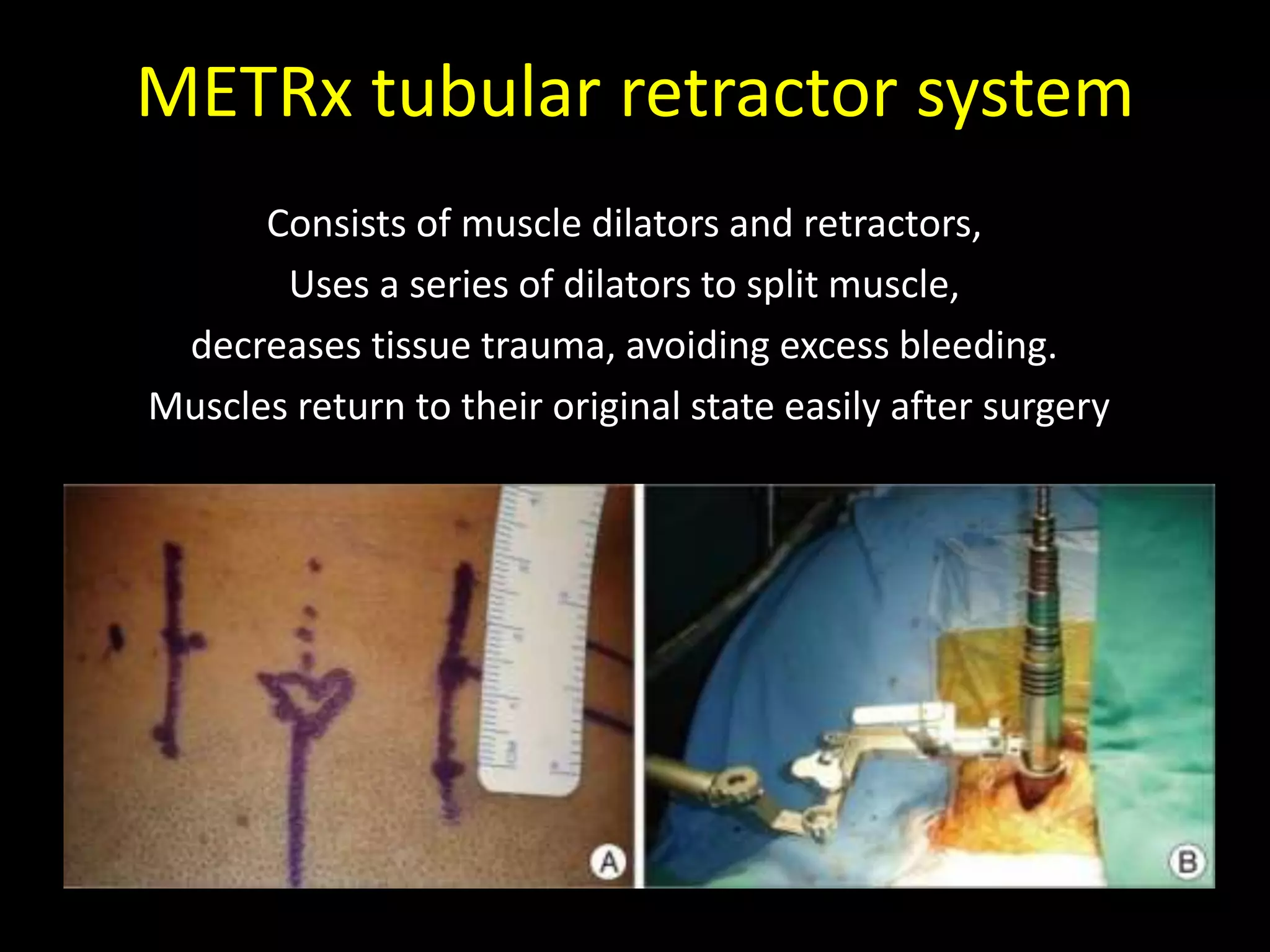 Posterior foraminotomy for cervical disc herniation | PPTX