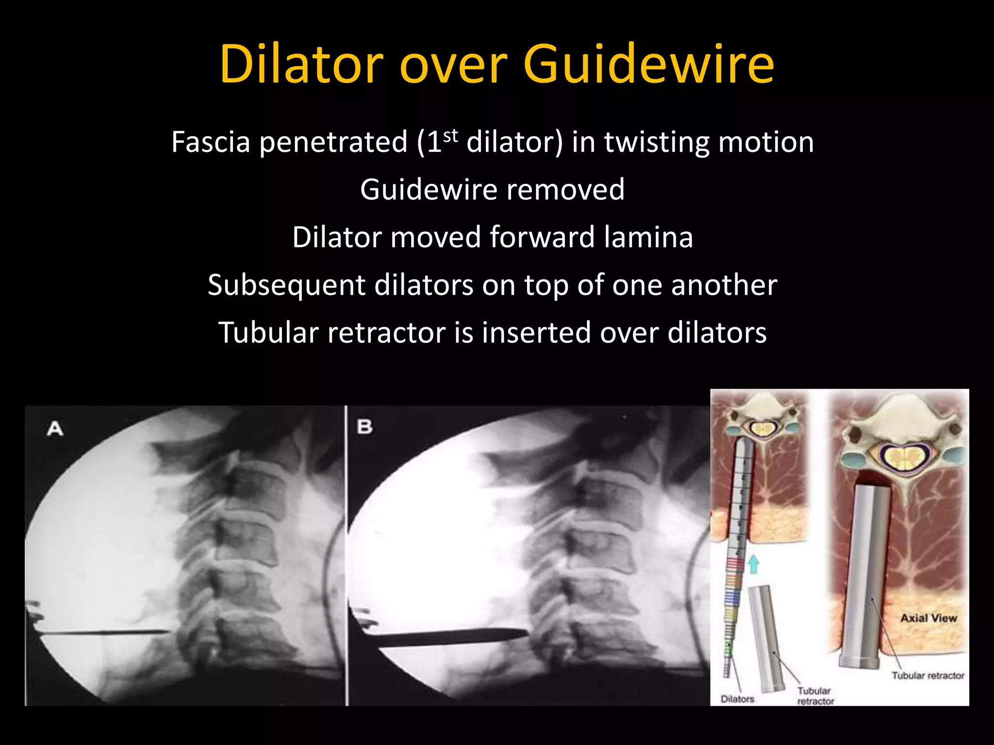 Posterior foraminotomy for cervical disc herniation | PPTX