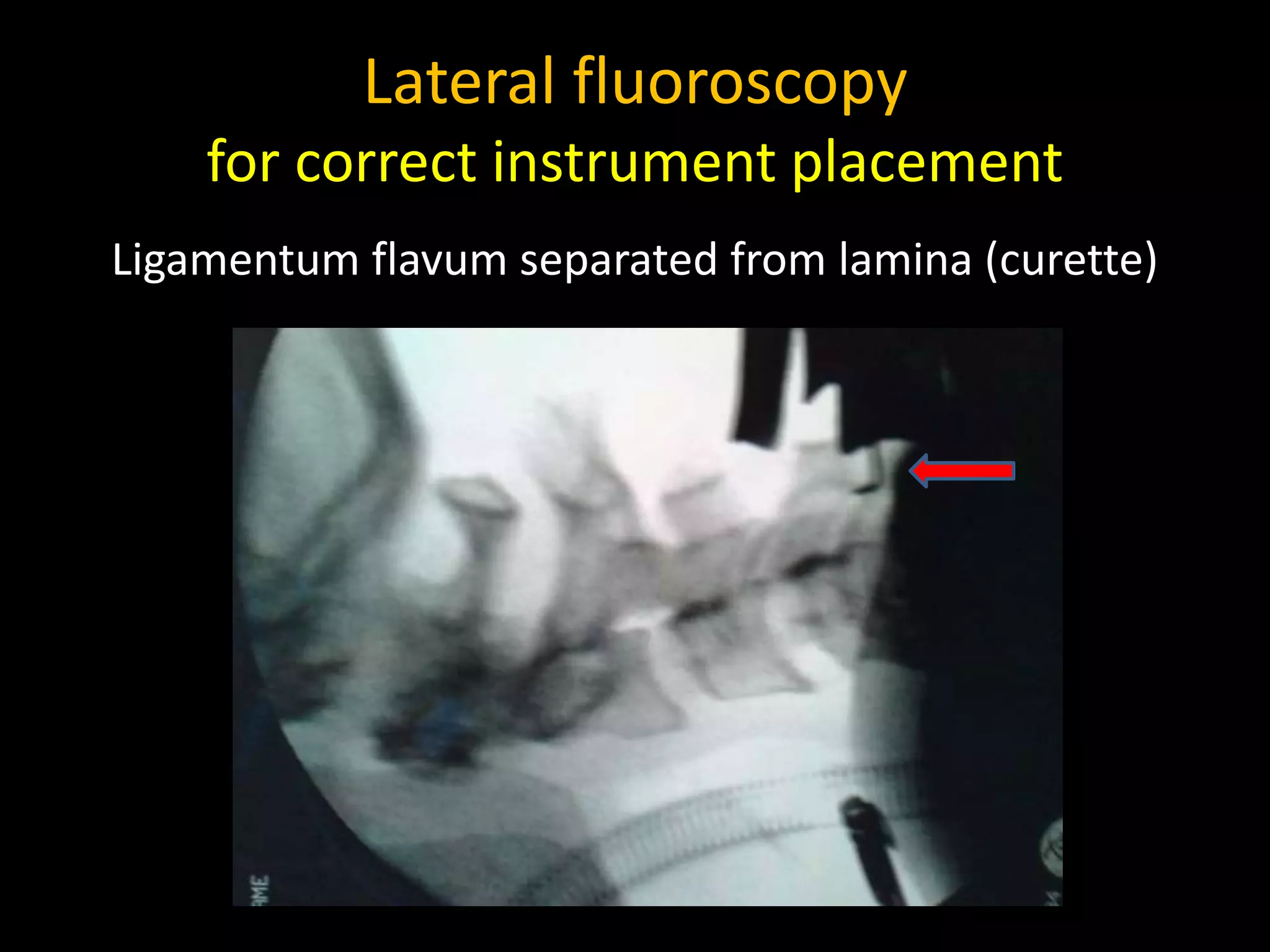 Posterior foraminotomy for cervical disc herniation | PPTX