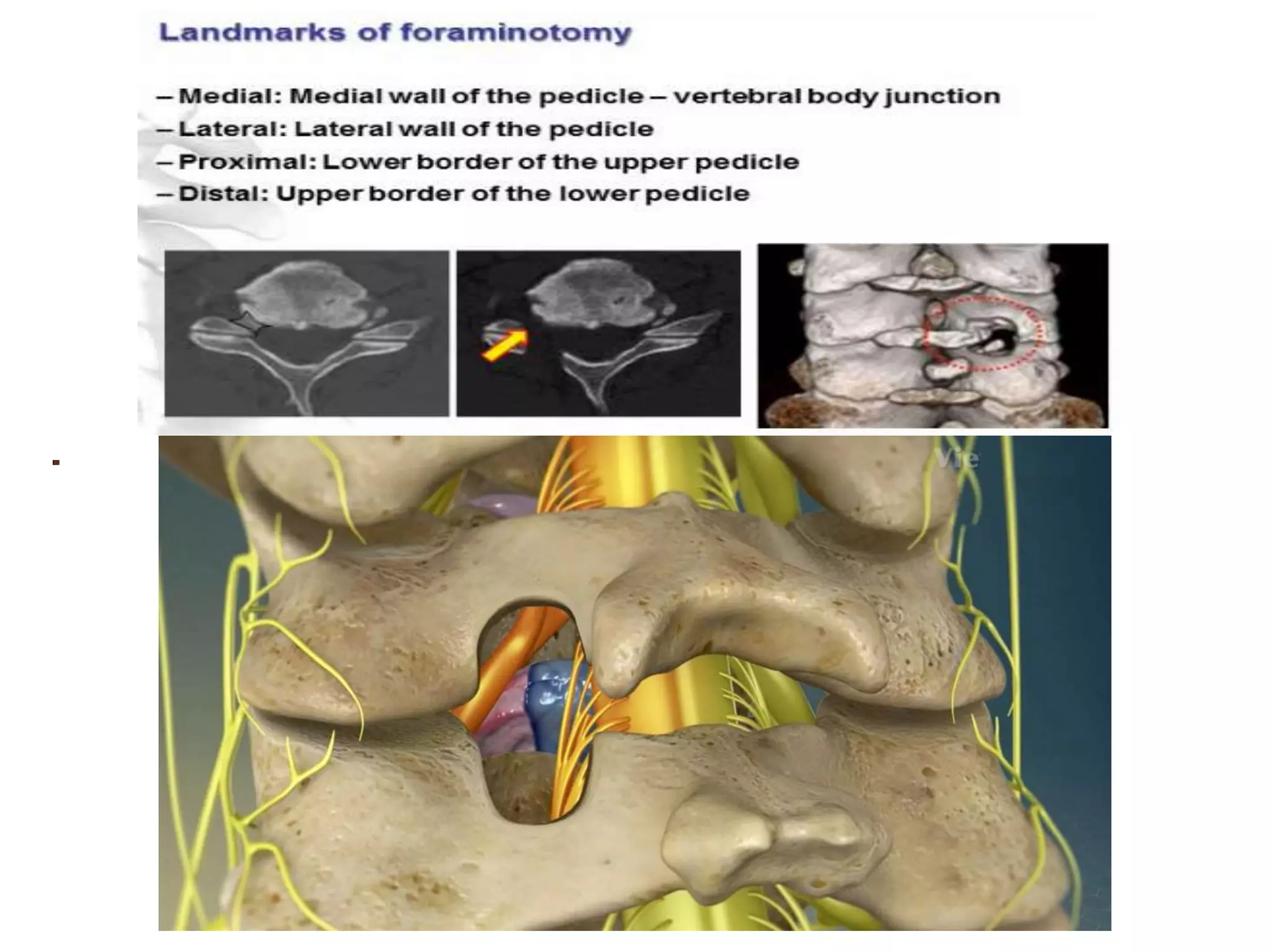 Posterior foraminotomy for cervical disc herniation | PPTX