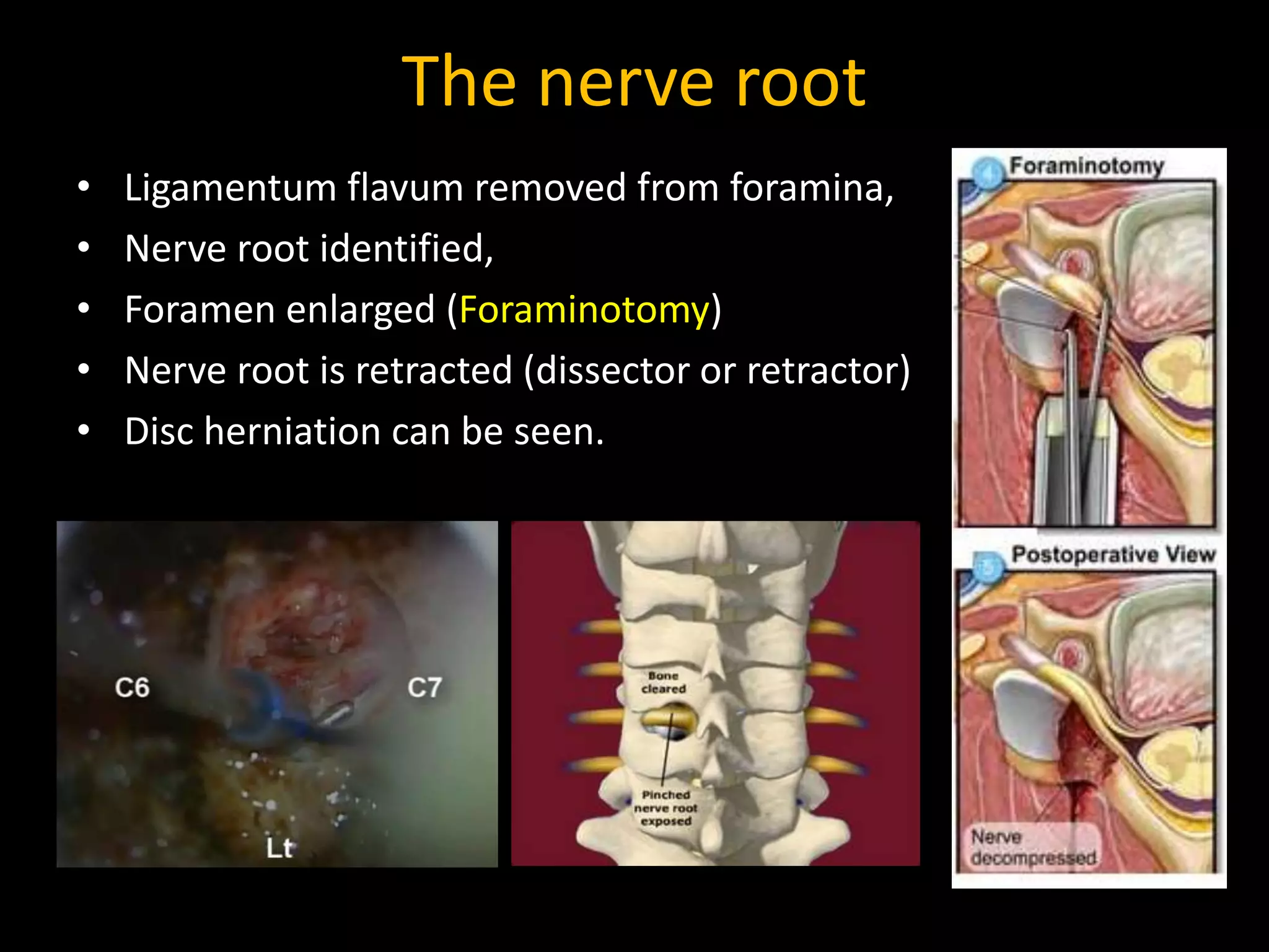 Posterior foraminotomy for cervical disc herniation | PPTX