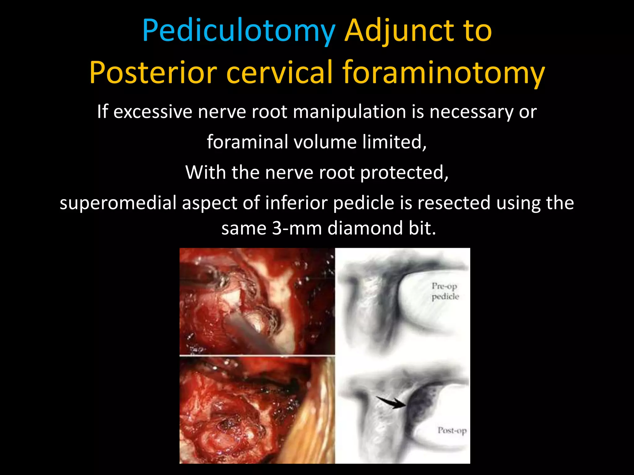 Posterior foraminotomy for cervical disc herniation | PPTX