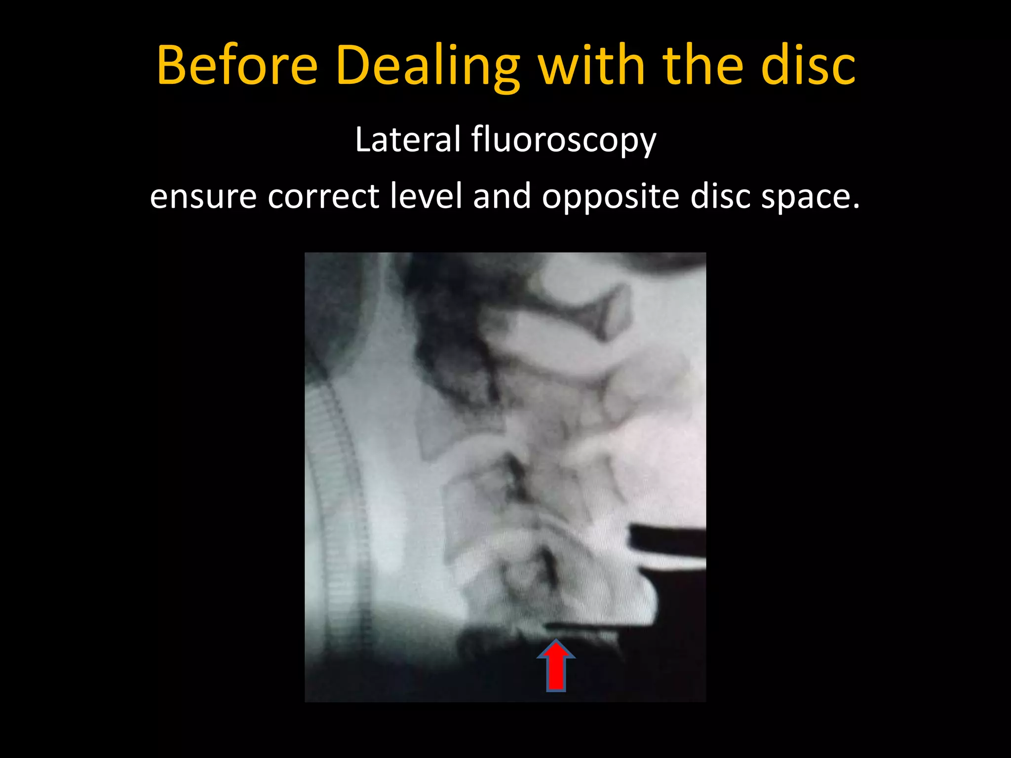 Posterior foraminotomy for cervical disc herniation | PPTX