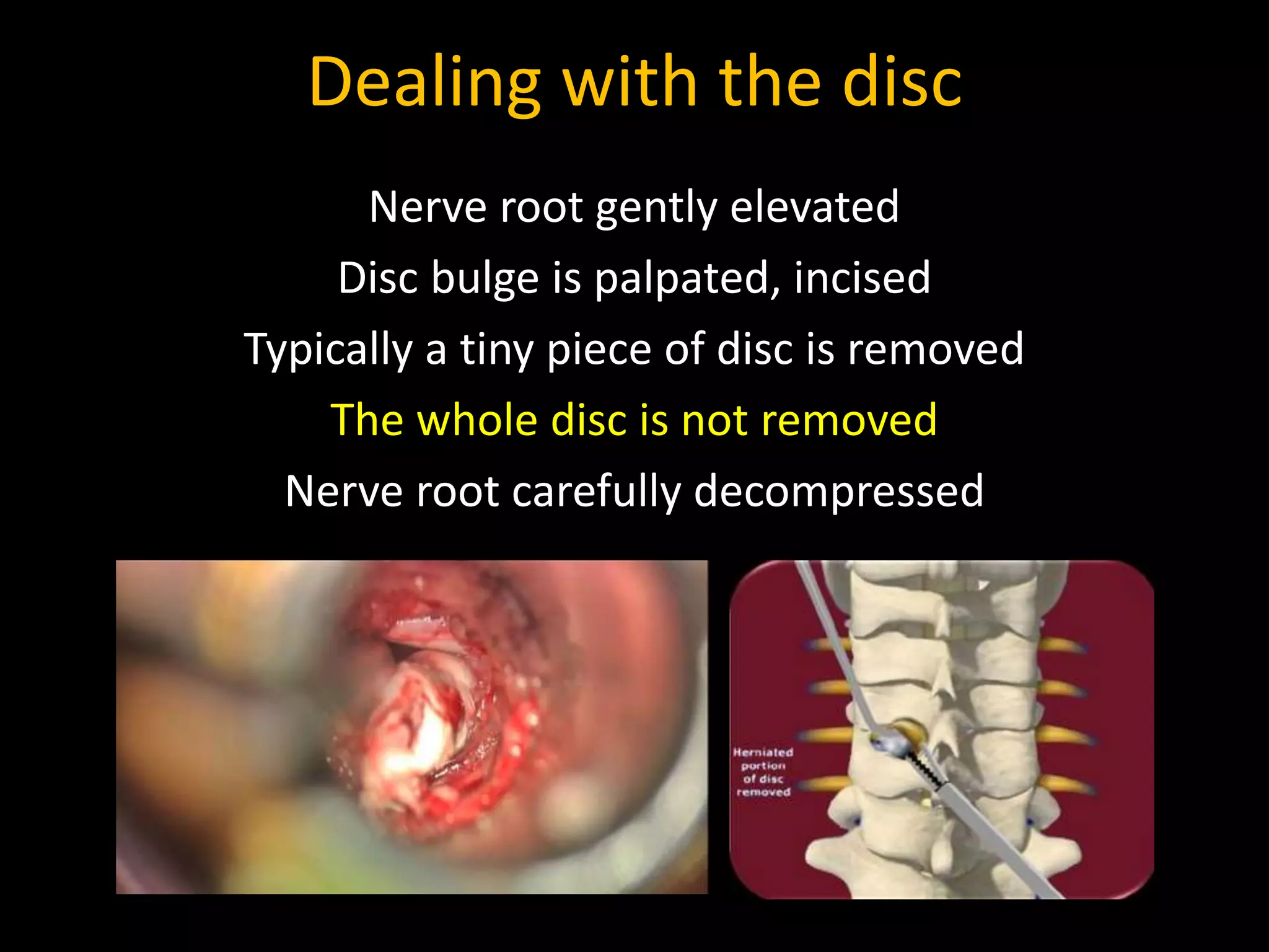 Posterior foraminotomy for cervical disc herniation | PPTX
